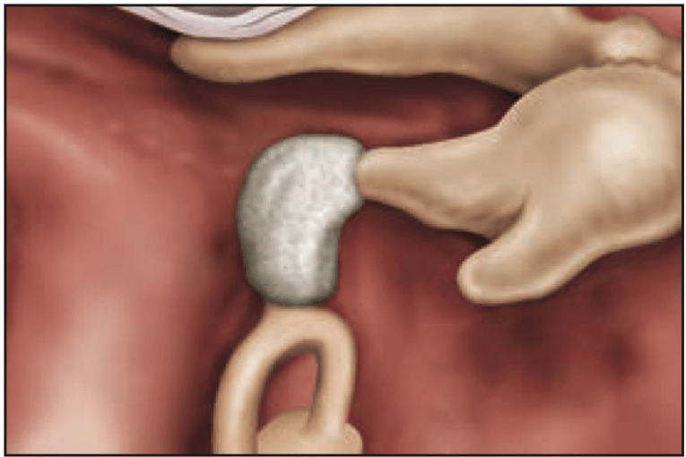 Ossiculoplasty: Indications, Surgery, and Recovery for Better Hearing